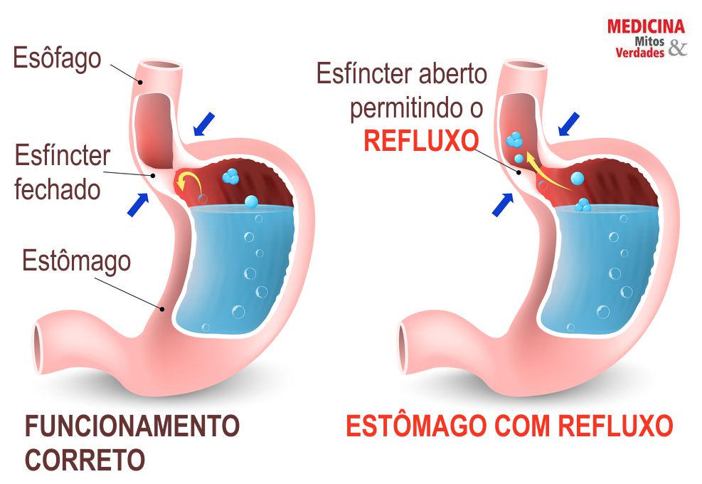 Refluxo Gastroesof gico Medicina Mitos E Verdades